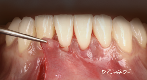 TCAF – Tunneled Coronally Advanced Flap technique | iPerio Courses in ...