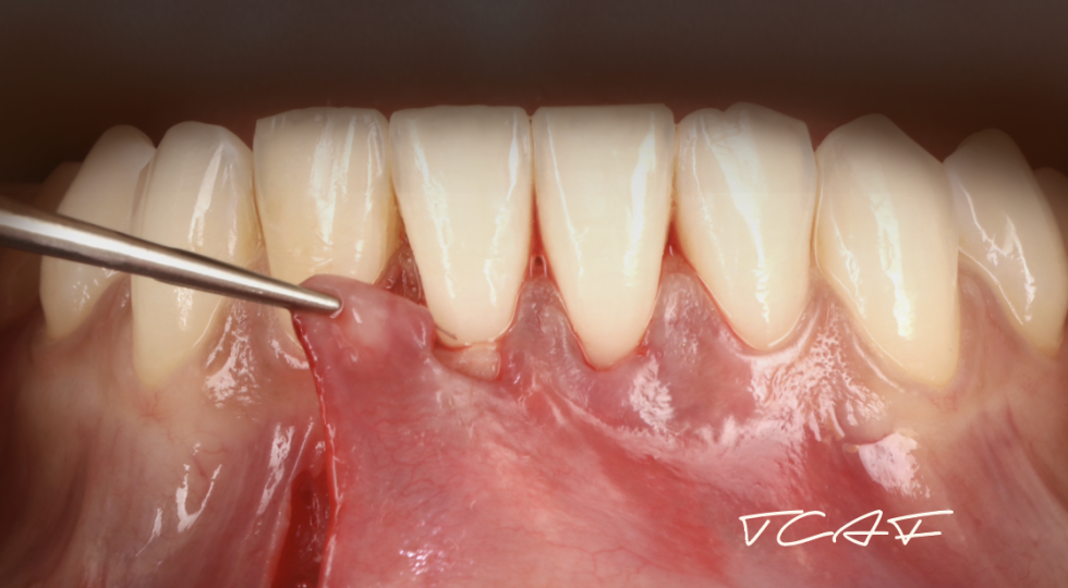 TCAF – Tunneled Coronally Advanced Flap technique | iPerio Courses in ...